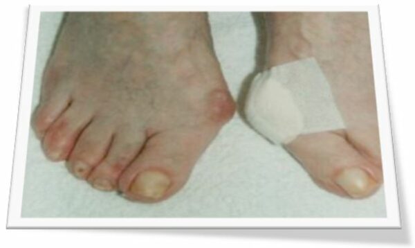HALLUX VALGUS - Medisch pedicure praktijk Dordrecht - Voetverzorging