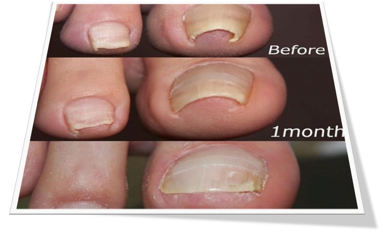 NAGELBEUGEL TECHNIEK - Medisch pedicure praktijk Dordrecht